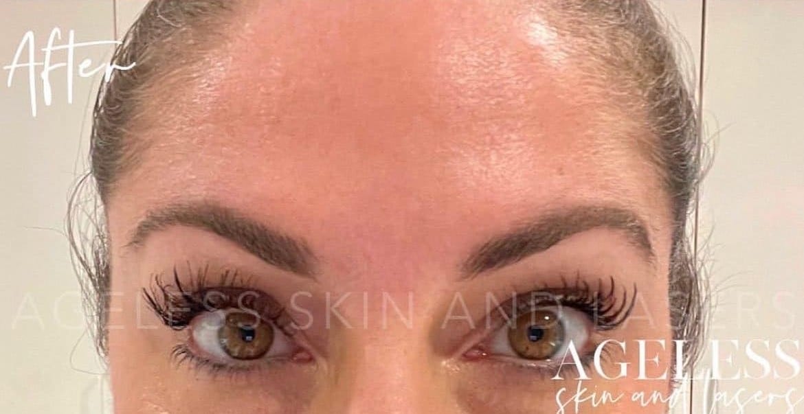 BOTOX - Ageless Skin & Laser Center