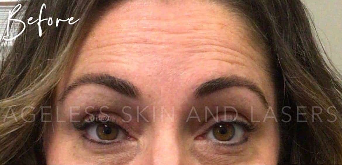 BOTOX - Ageless Skin & Laser Center