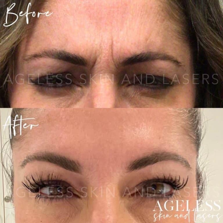 Botox – Brenza Beauty: Ageless Skin and Laser Center