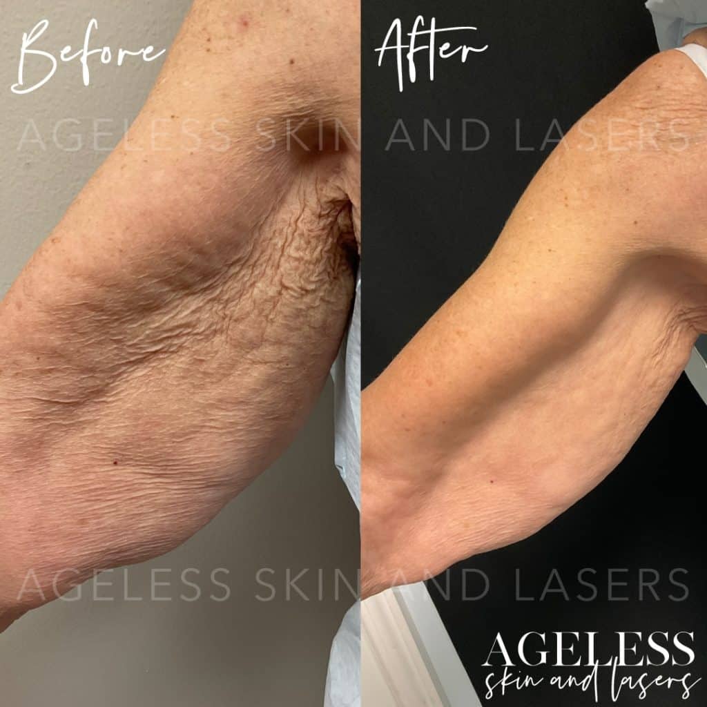 Exilis – Brenza Beauty: Ageless Skin and Laser Center