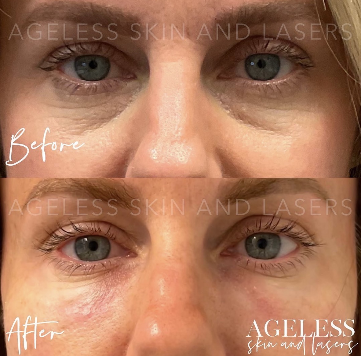 Platelet Rich Fibrin (PRF) - Ageless Skin and Lasers
