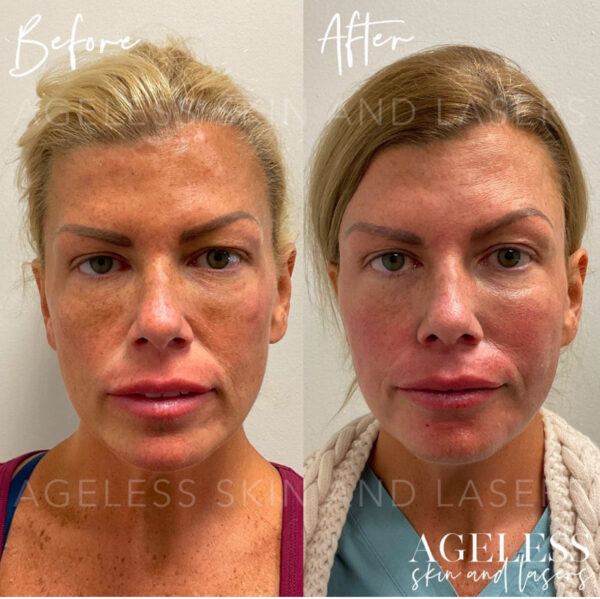 Sculptra - Ageless Skin and Lasers